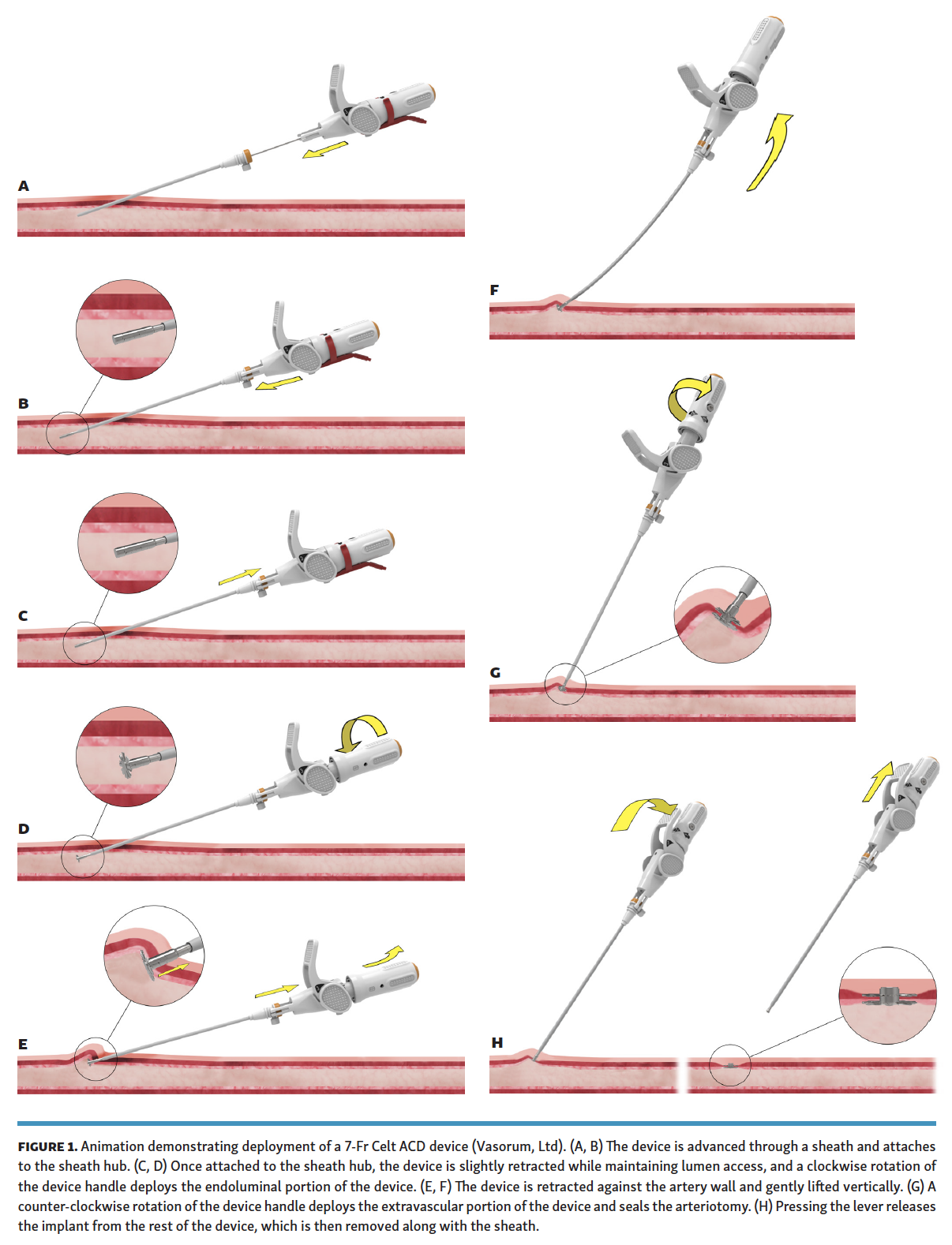 A Single-Center, Single-Operator Experience With the Celt ACD Vascular Closure Device in ...